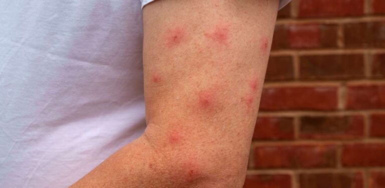 7 feiten en fabels over muggen - Rode Kruis Nederland