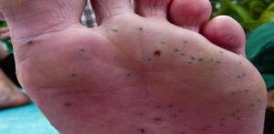 Steek van een zee-egel - Rode Kruis Nederland