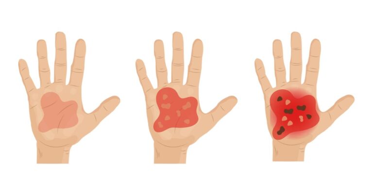 Wat doe je bij een brandwond door vuurwerk tijdens oud en nieuw?